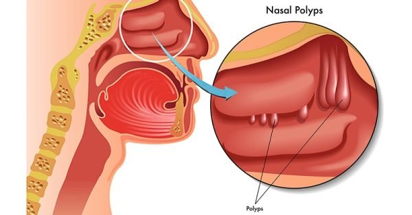 Nasal Polyps: Causes, Symptoms, Diagnosis, and Treatment - Allergy Gate